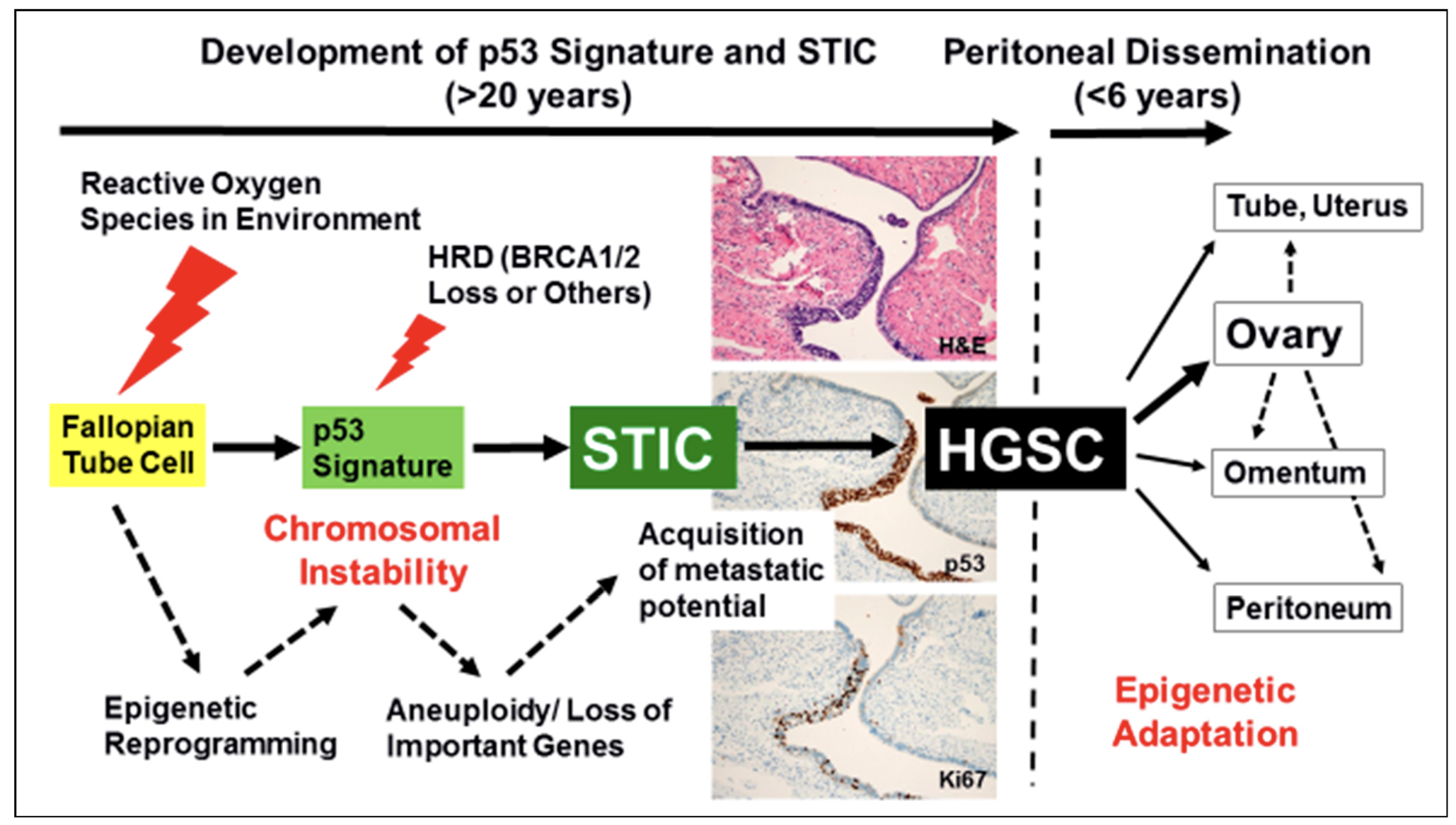 Ovarian Cancer Screening: Where Do We Stand Now ? - Academia.edu